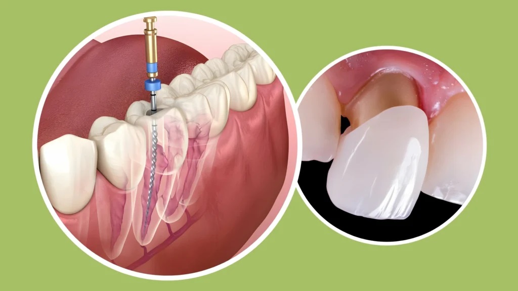 Why a Dental Crown Is Compulsory After Root Canal Treatment